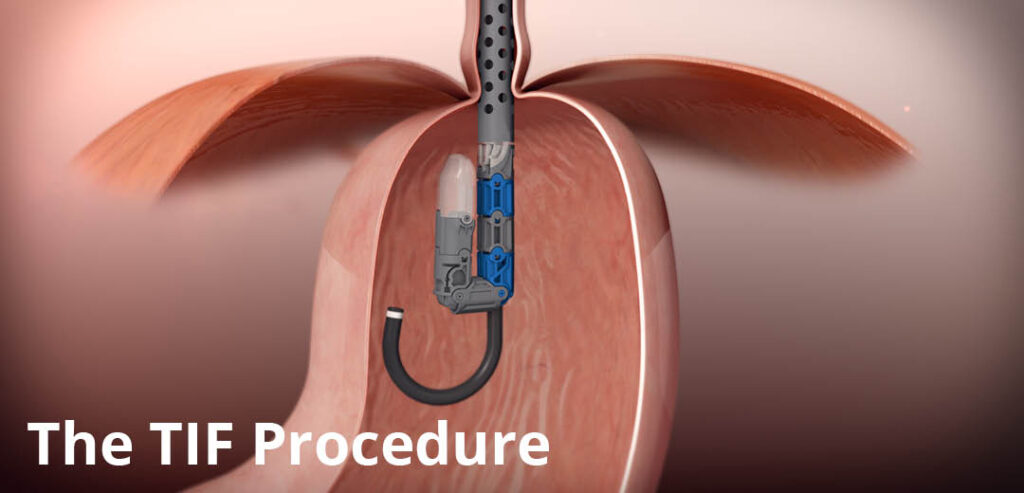 TIF Procedure - Gastroenterology Consultants of Augusta
